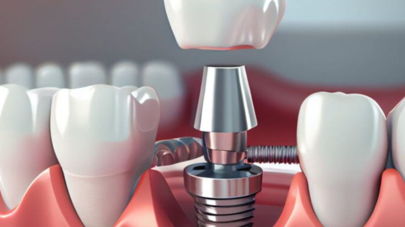Why Choose a Single Tooth Implant? Benefits, Procedure